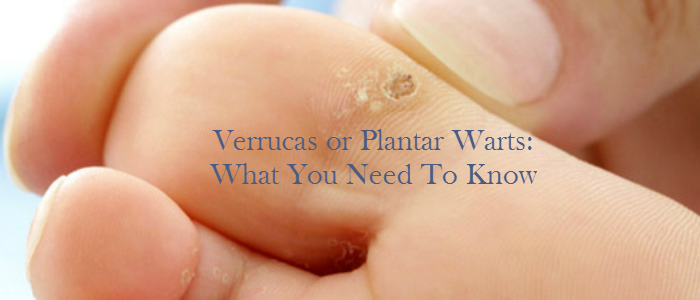 Verrucas Or Plantar Warts What You Need To Know Uk