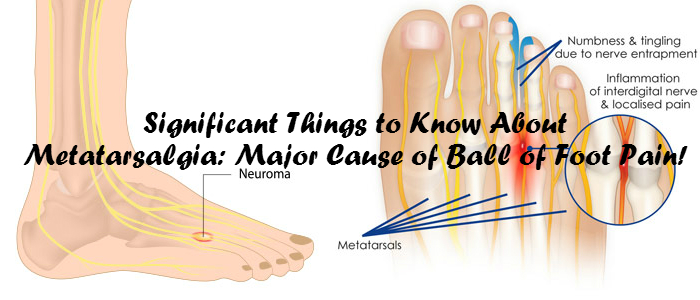 Significant Things to Know About Metatarsalgia: Major Cause of Ball of ...