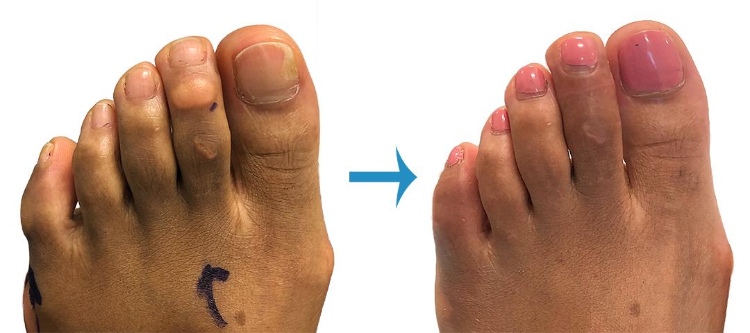 Before And After Foot Surgery - Image Gallery | London Foot & Ankle Surgery