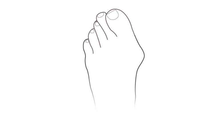How Much Does a Tailor's Bunion Surgery Cost?