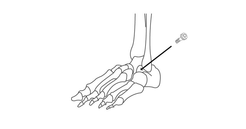 HyProCure Procedure - Flatfoot Correction | London Foot and Ankle Surgery