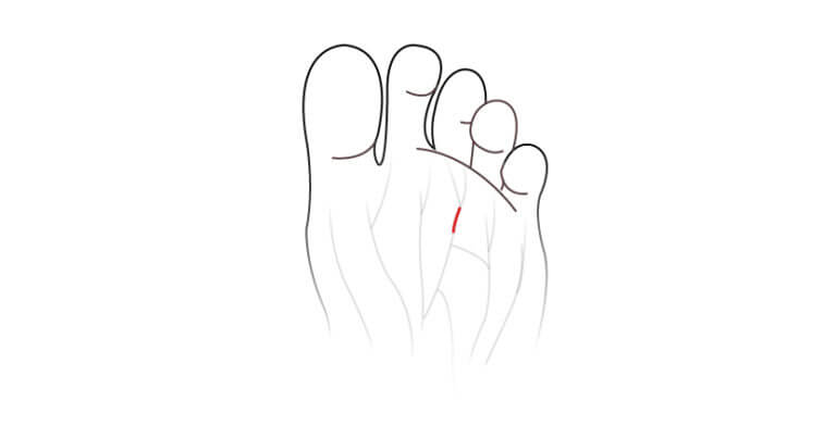 Foot Corns and Callus Removal Treatment| causes | Specialist Foot ...