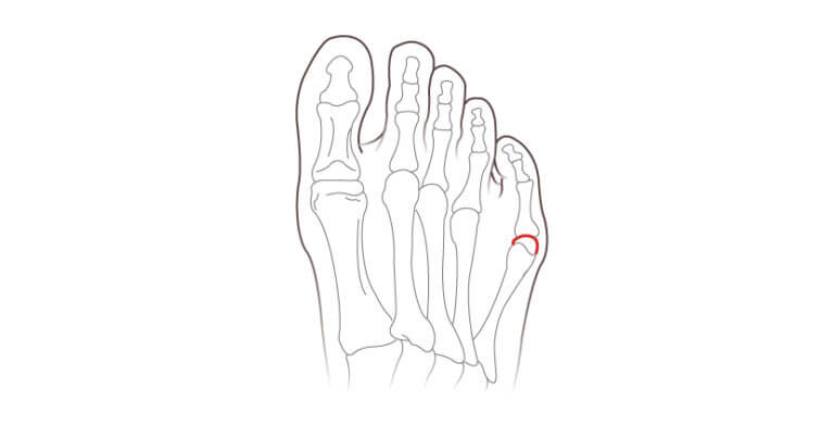 Bursa Lesions on Toes: Causes, Treatment & Recovery