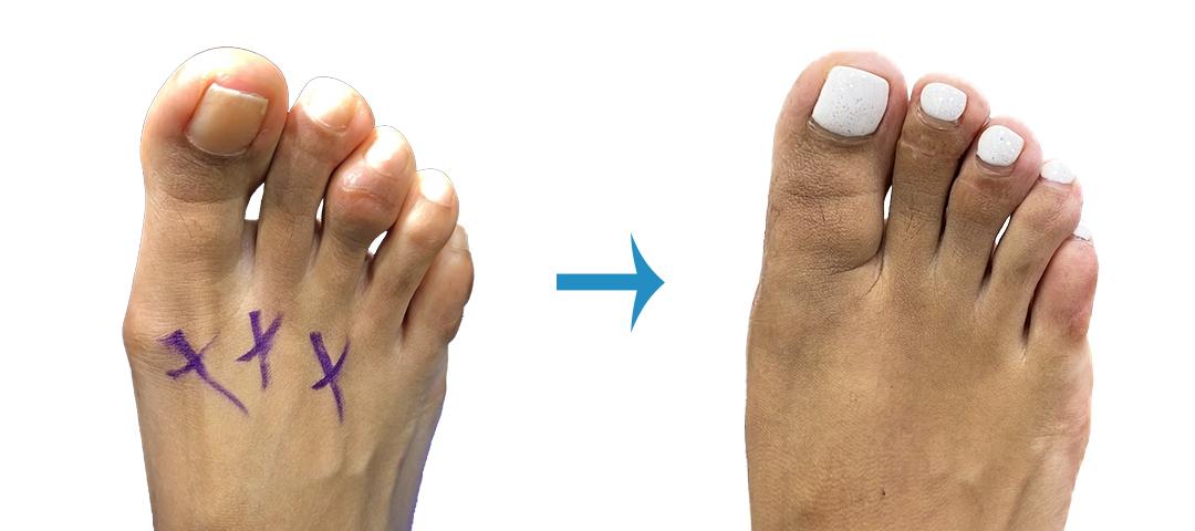 Before And After Foot Surgery - Image Gallery | London Foot & Ankle Surgery