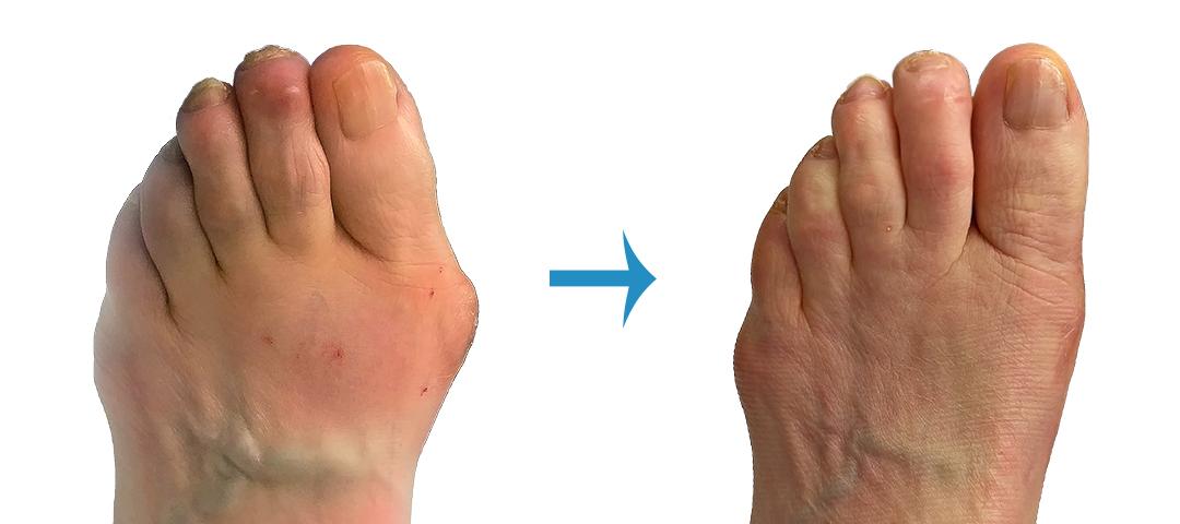 Before And After Foot Surgery - Image Gallery | London Foot & Ankle Surgery