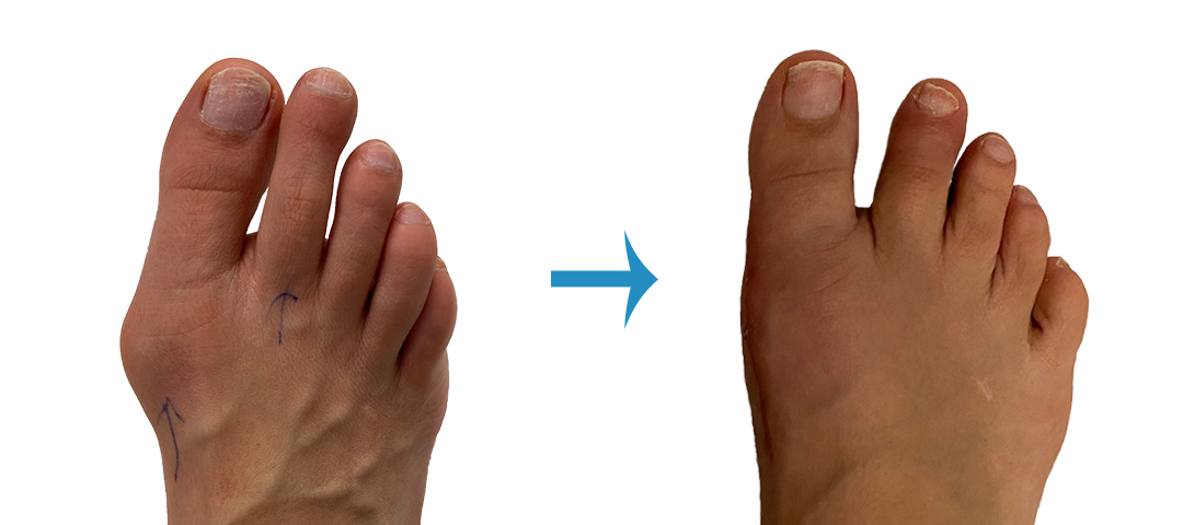 Before And After Foot Surgery - Image Gallery | London Foot & Ankle Surgery