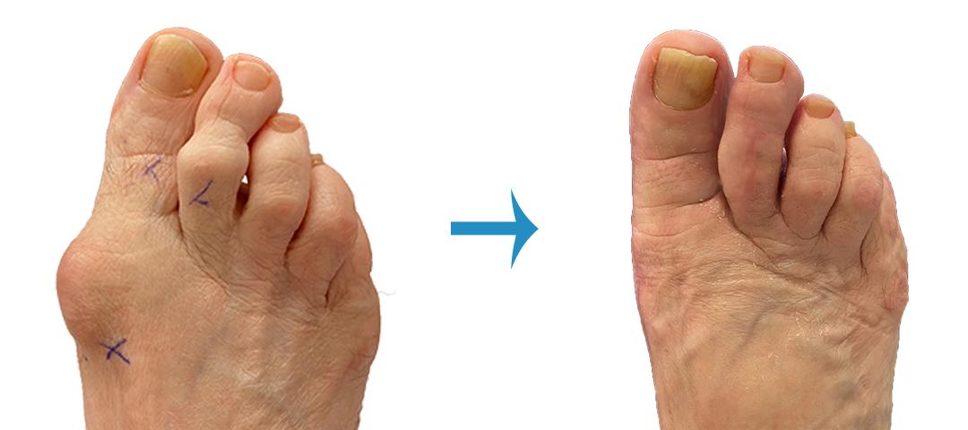 Before And After Foot Surgery - Image Gallery | London Foot & Ankle Surgery