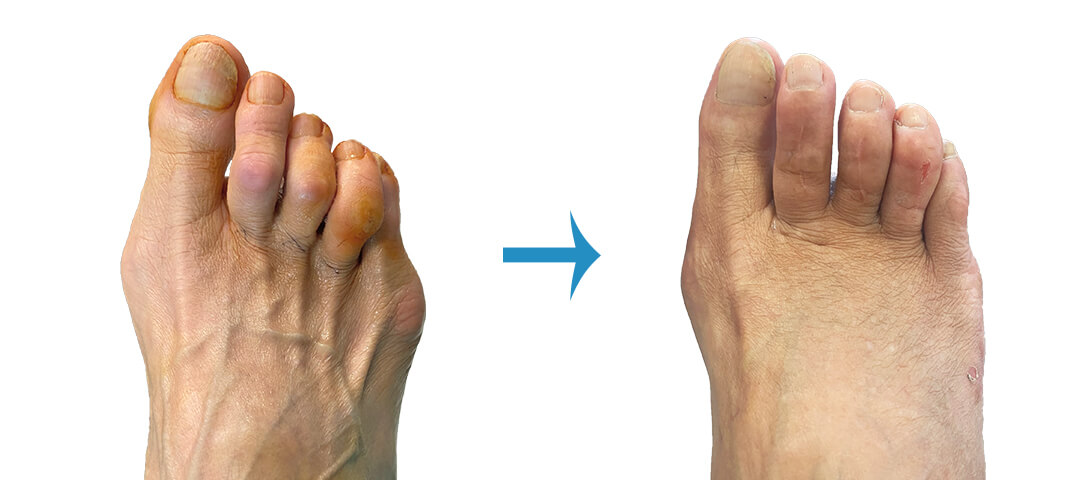 Before And After Foot Surgery - Image Gallery | London Foot & Ankle Surgery