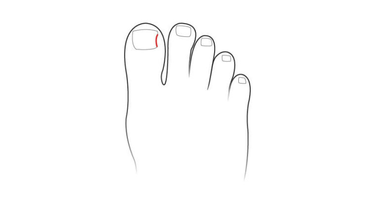 Different Types of Hammertoe Surgery: Procedures & Recovery