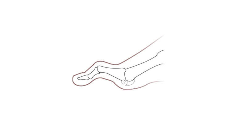 Different Types of Hammertoe Surgery: Procedures & Recovery