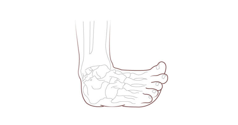High Ankle Sprain vs Regular Ankle Sprain: Key Differences