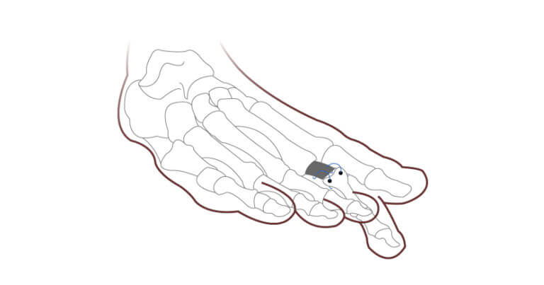 Different Types of Hammertoe Surgery: Procedures & Recovery
