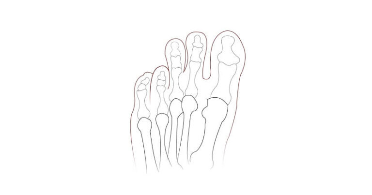 Different Types of Hammertoe Surgery: Procedures & Recovery