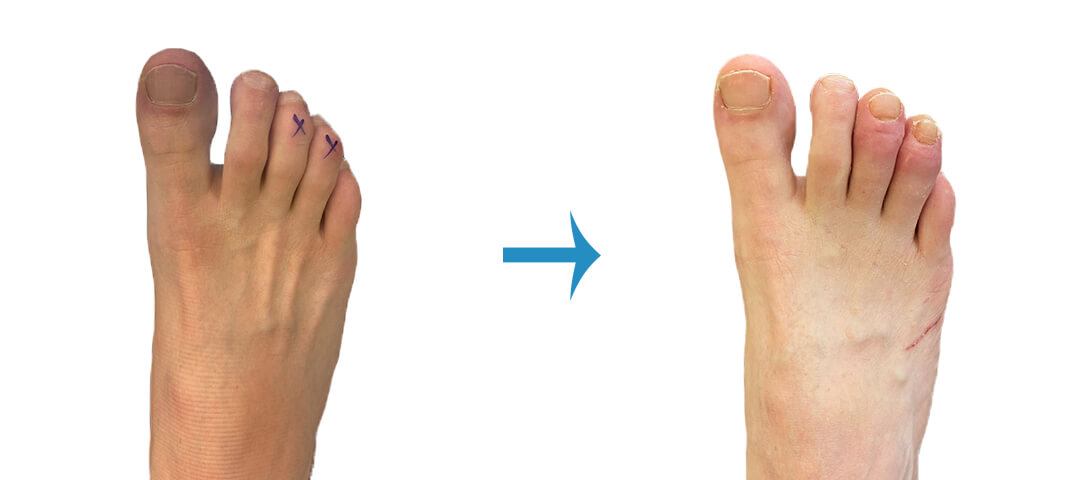 Before And After Foot Surgery - Image Gallery | London Foot & Ankle Surgery