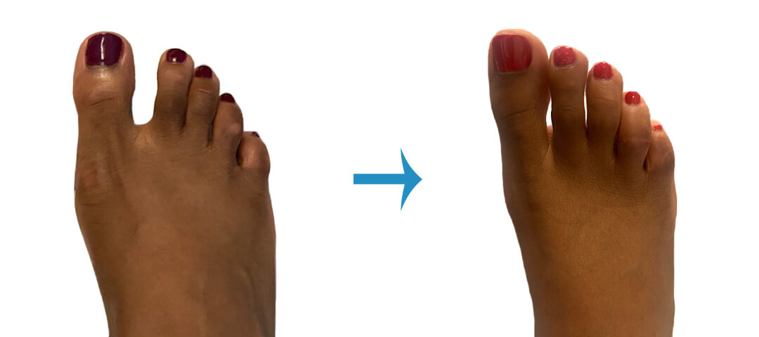Before And After Foot Surgery - Image Gallery | London Foot & Ankle Surgery
