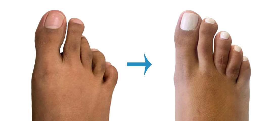 Before And After Foot Surgery - Image Gallery | London Foot & Ankle Surgery