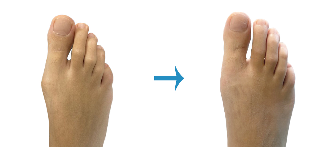 Before And After Foot Surgery - Image Gallery | London Foot & Ankle Surgery