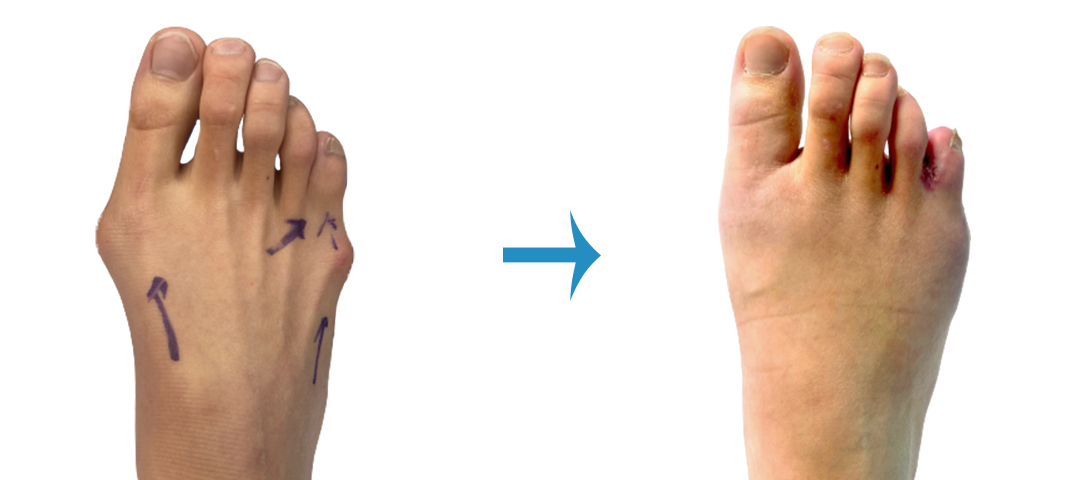 Before And After Foot Surgery - Image Gallery | London Foot & Ankle Surgery