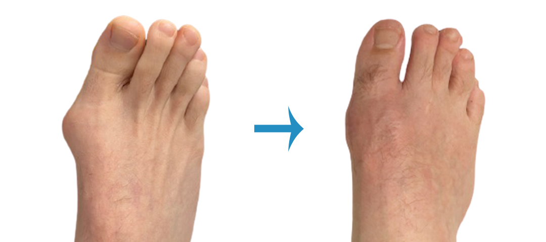Before And After Foot Surgery - Image Gallery | London Foot & Ankle Surgery