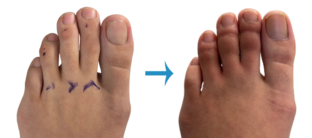 Before And After Foot Surgery - Image Gallery | London Foot & Ankle Surgery