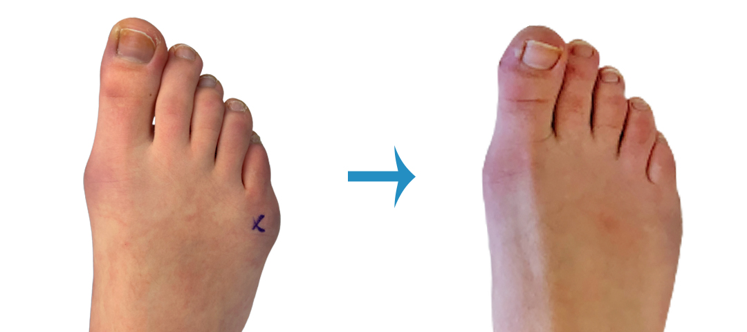 Before And After Foot Surgery - Image Gallery | London Foot & Ankle Surgery