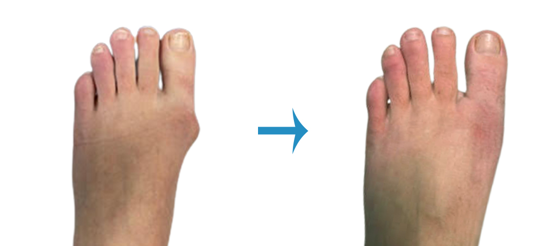 Before And After Foot Surgery - Image Gallery | London Foot & Ankle Surgery
