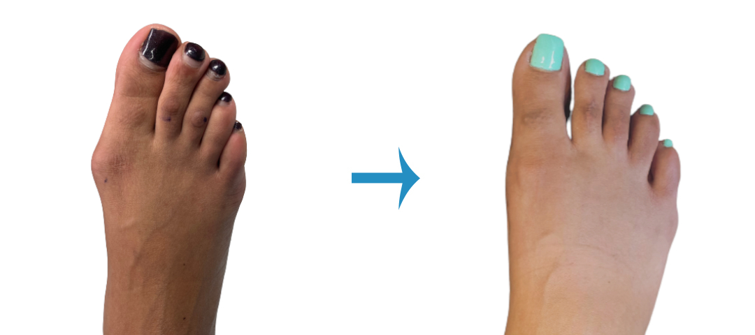 Before And After Foot Surgery - Image Gallery | London Foot & Ankle Surgery
