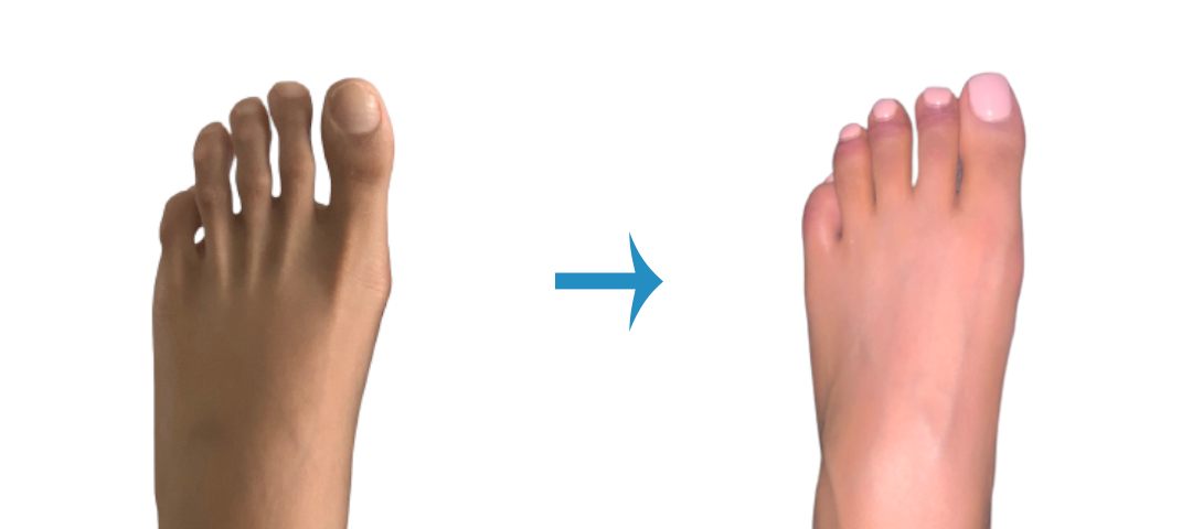 Scarf Akin Bunionectomy