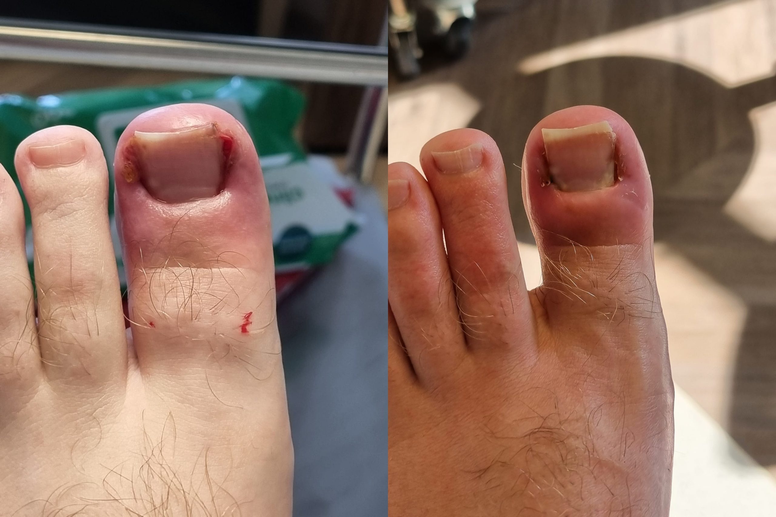 Ingrown Toenail Removal & Surgery at London | Symptoms & Causes